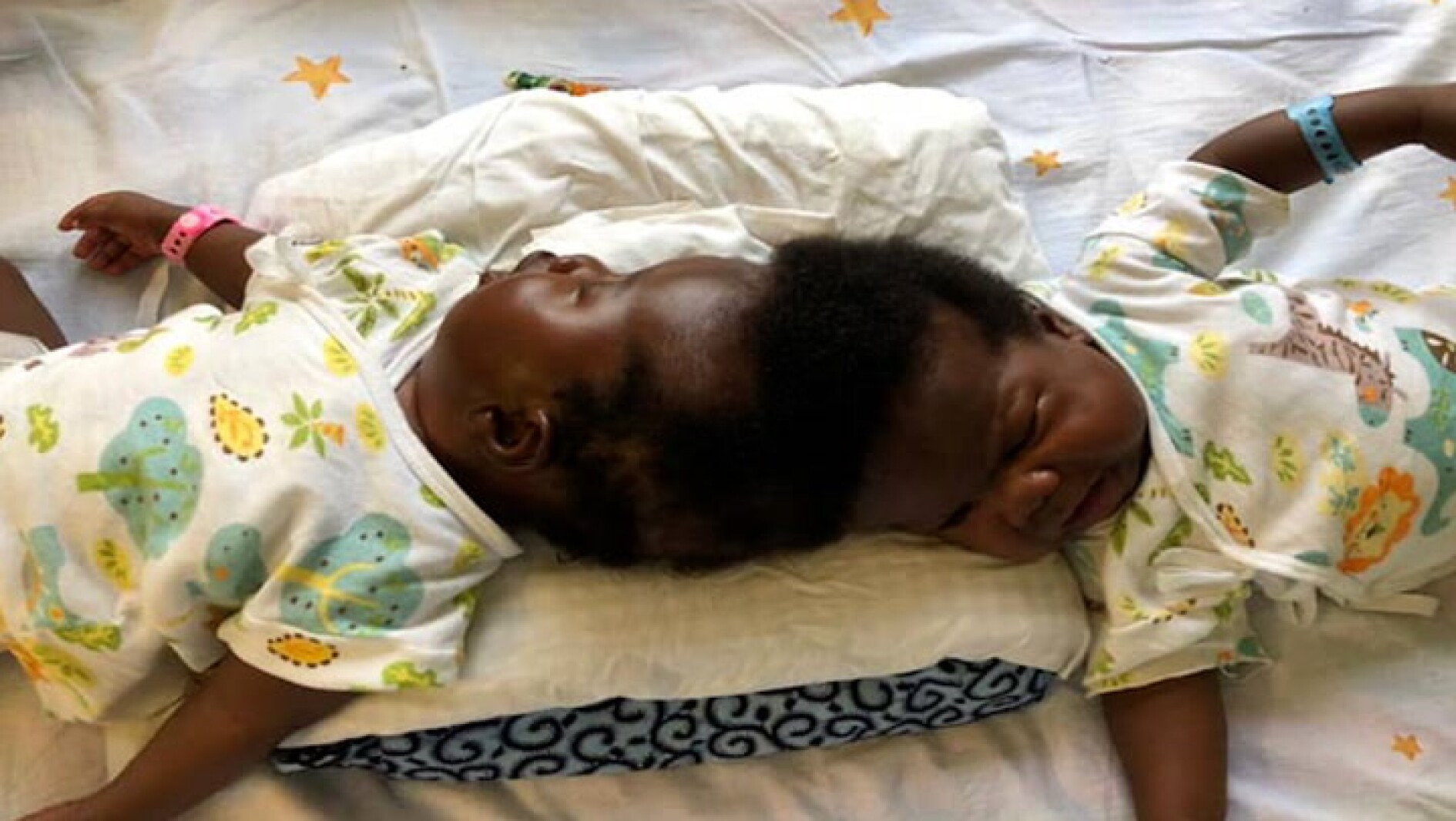 Myostatin Deficiency Baby